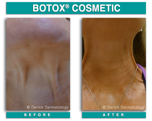 Dermatology Before and After | Botox, Latisse, CoolSculpting