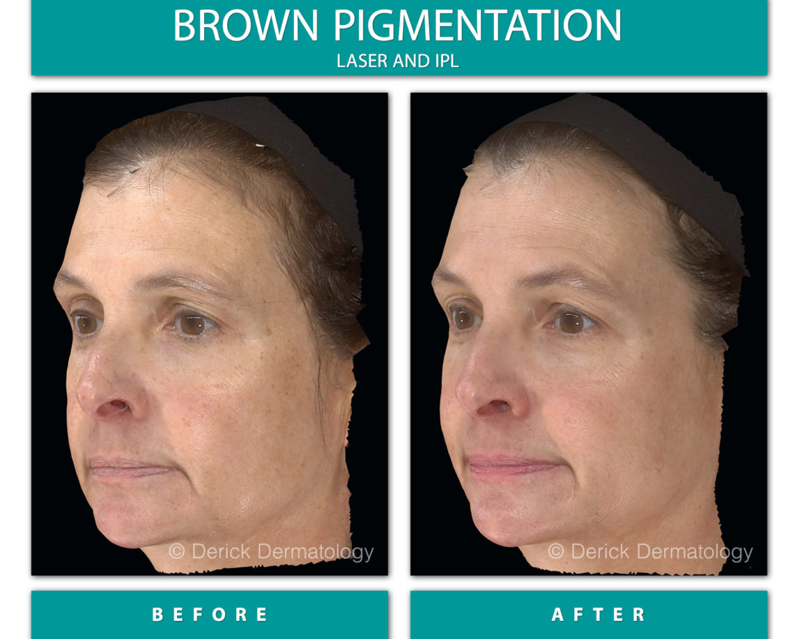 Before and After Brown Pigment Gallery - Derick Dermatology