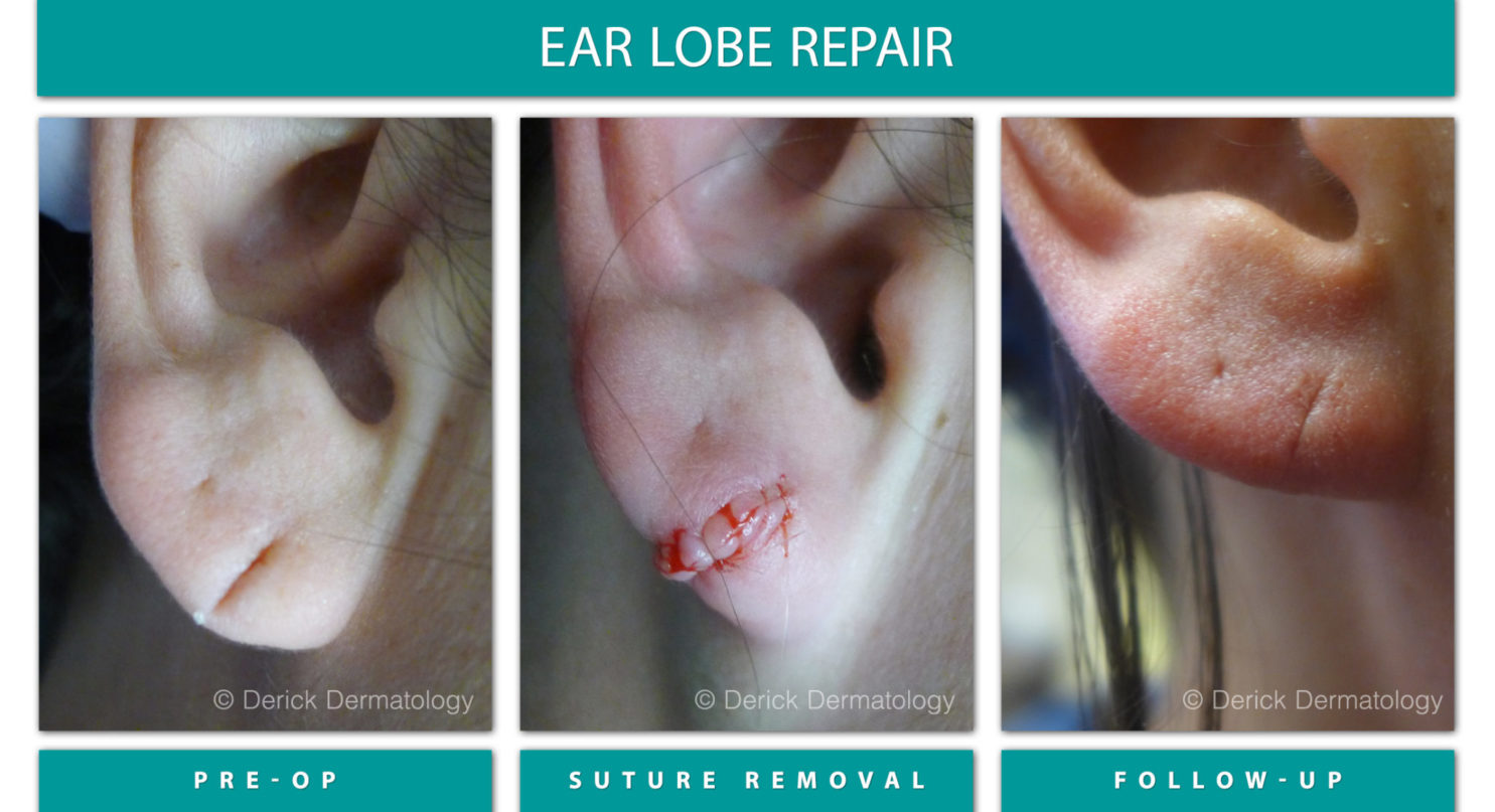 Before & After Gallery - Ear Lobe Repair - Derick Dermatology
