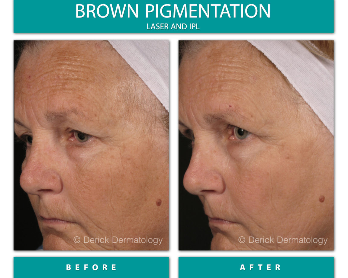 Before and After Brown Pigment Gallery - Derick Dermatology