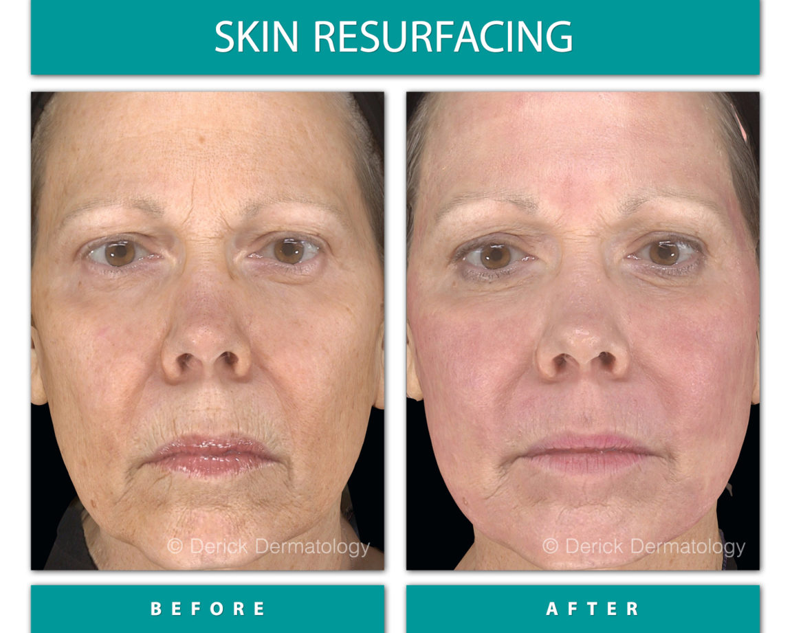 Before & After Gallery - Skin Resurfacing - Derick Dermatology