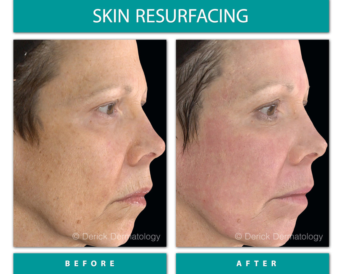 Before & After Gallery - Skin Resurfacing - Derick Dermatology