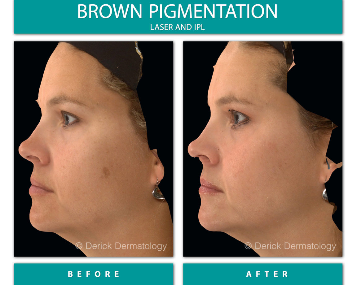 Before and After Brown Pigment Gallery - Derick Dermatology