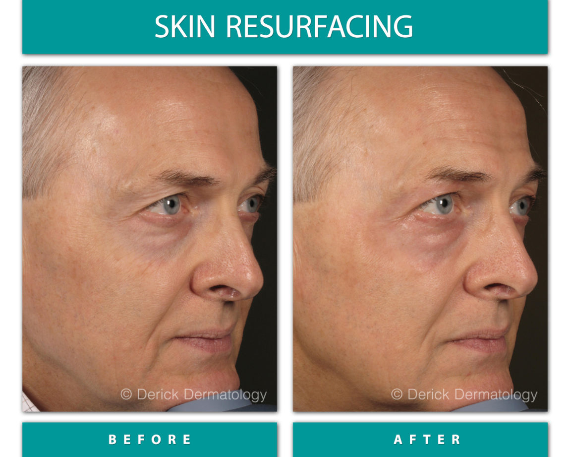 Before & After Gallery - Skin Resurfacing - Derick Dermatology