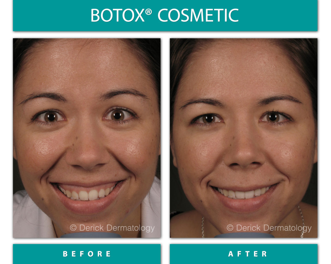 Before & After Gallery - Botox® - Derick Dermatology