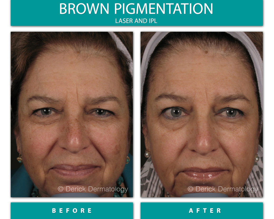 Before and After Brown Pigment Gallery - Derick Dermatology