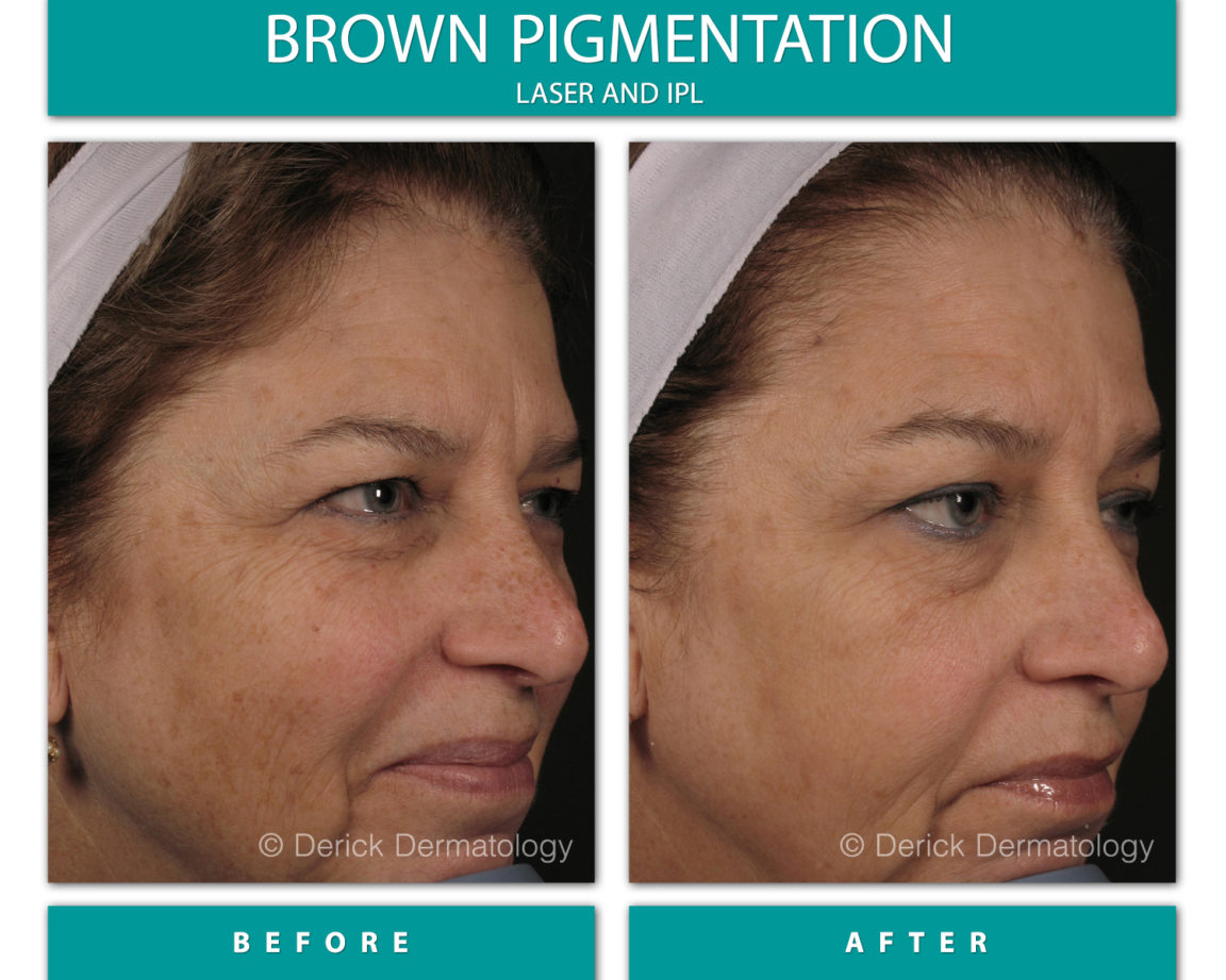 Before and After Brown Pigment Gallery - Derick Dermatology