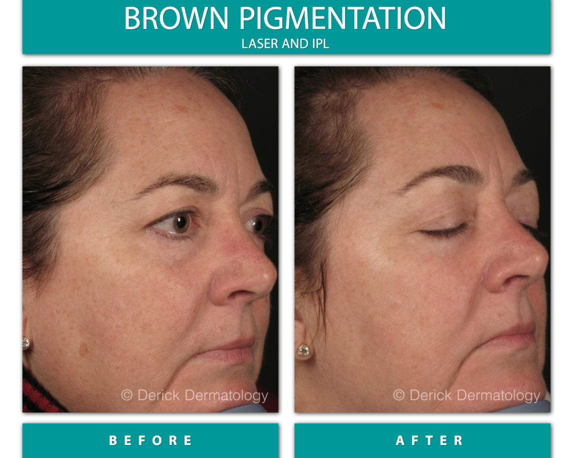 Before and After Brown Pigment Gallery - Derick Dermatology