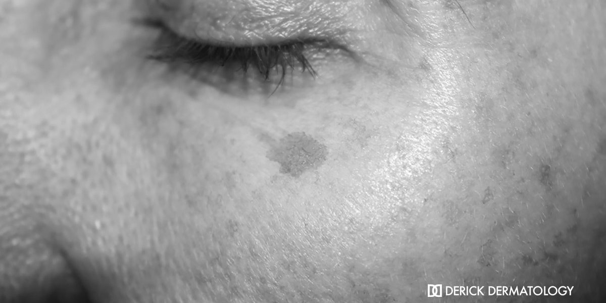 Sun Damaged Skin - How Sunlight Damages Your Skin