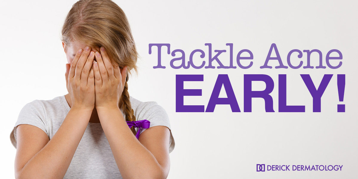 Tackle Acne Early - Treating Acne - Derick Dermatology