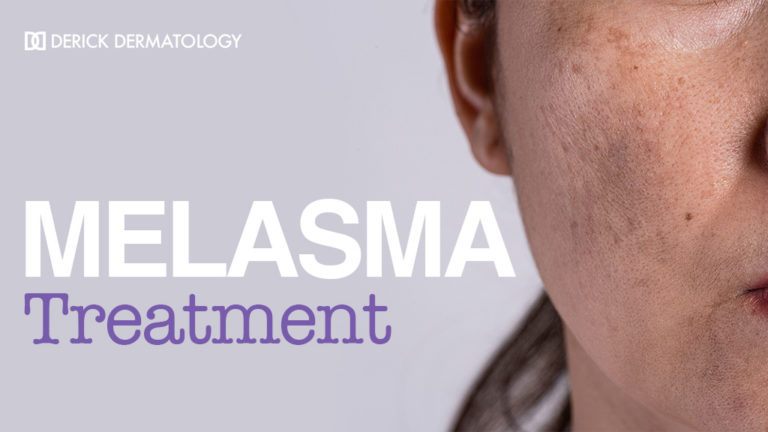 Melasma Treatment | Medical Dermatology | Derick Dermatology